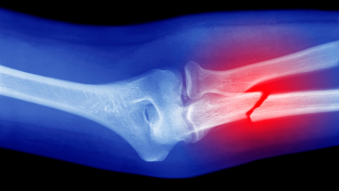 A handheld ‘bone printer’ exhibits promise in animal exams - YACAK